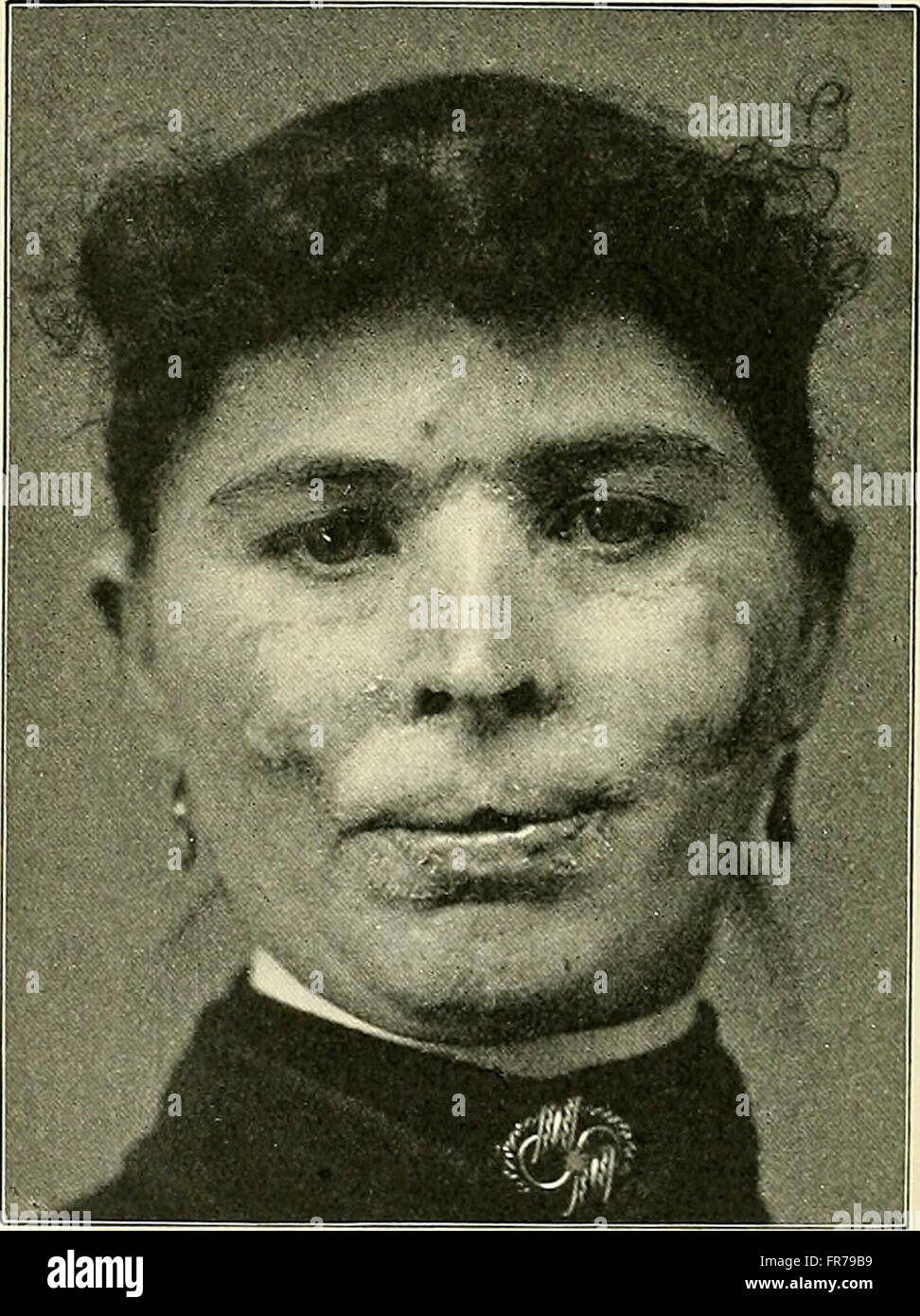 This 1898 medical textbook covers diseases of the genito-urinary system ...