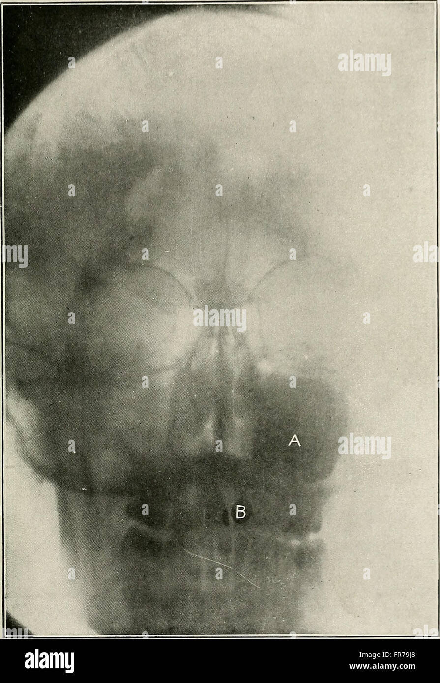 Bismuth paste in chronic suppurations, its diagnostic importance and ...