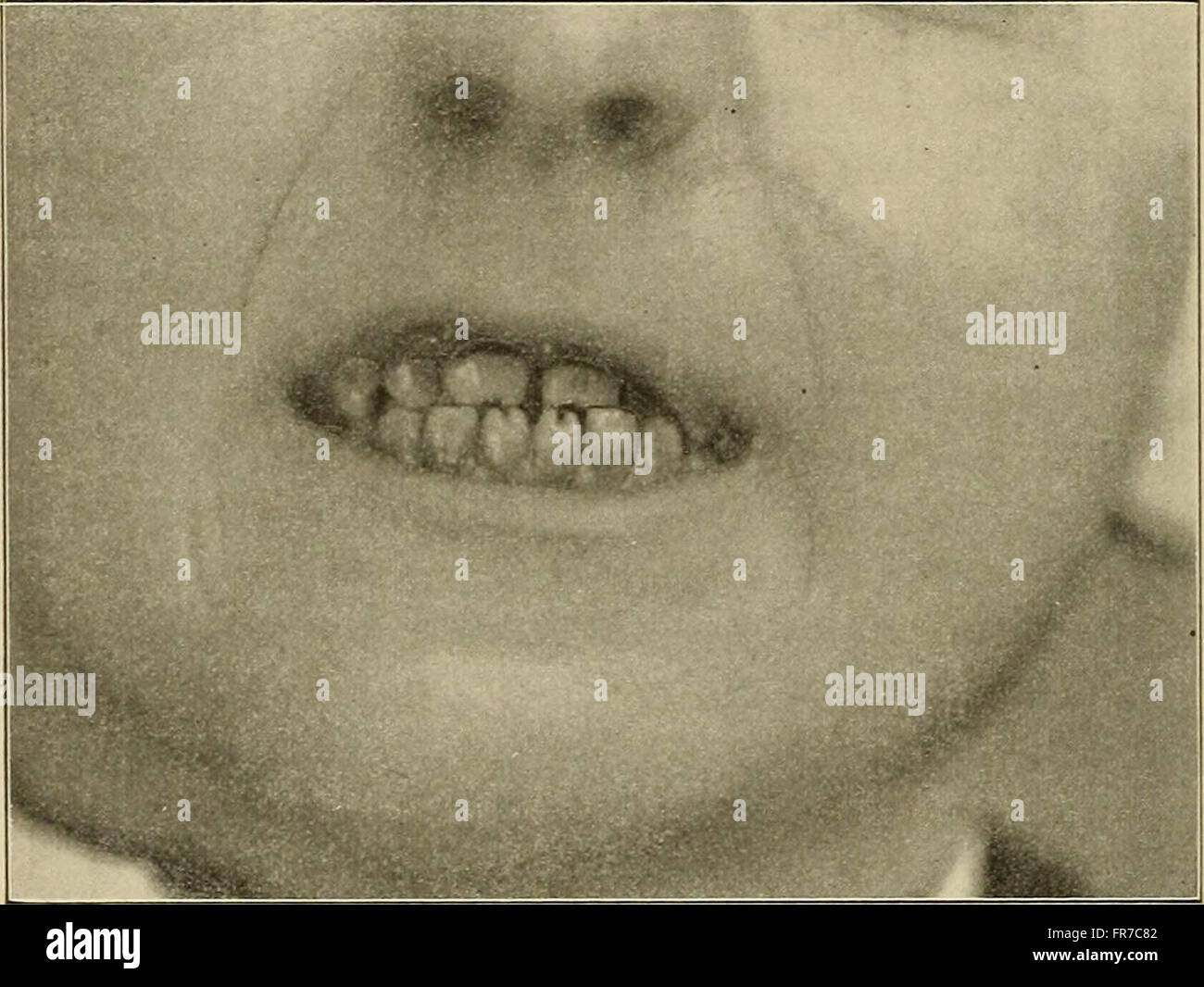 A manual of syphilis and the venereal diseases, (1900 Stock Photo - Alamy