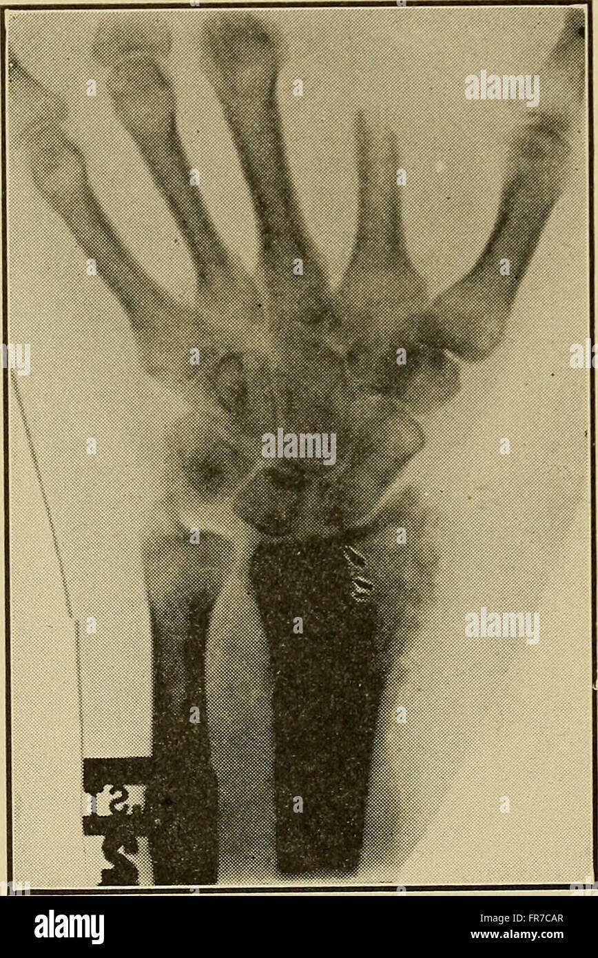 'Diseases of Bones and Joints' (1914) provides detailed descriptions of ...
