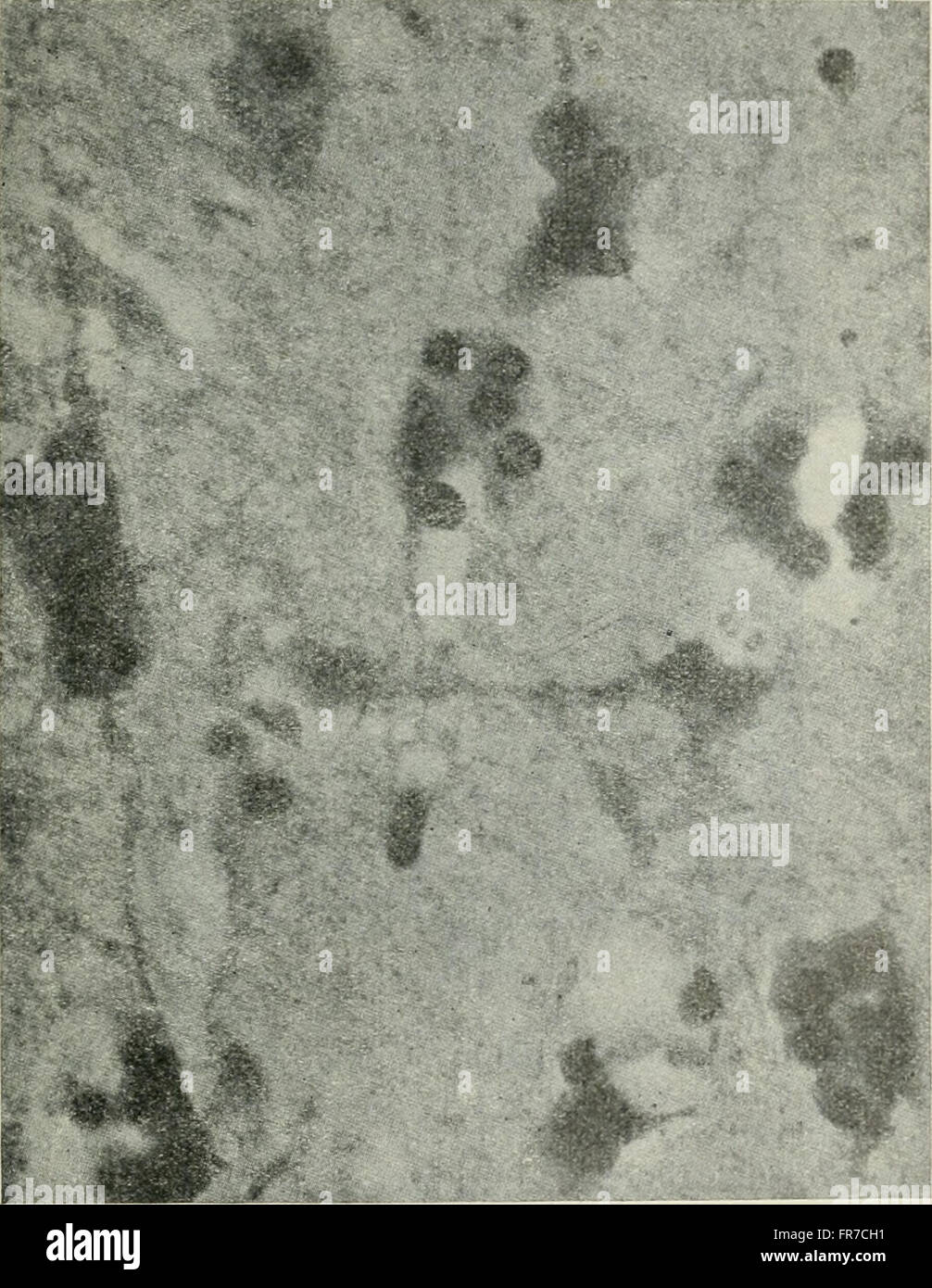 This 1919 text examines the psychiatric conditions dementia praecox and ...