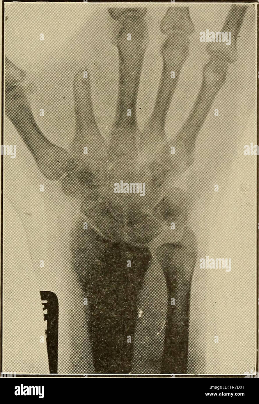 Diseases of Bones and Joints (1914) is a medical text that discusses ...