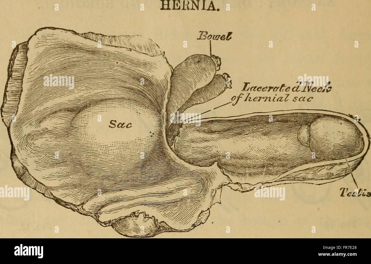 Strangulated hernia hi-res stock photography and images - Alamy