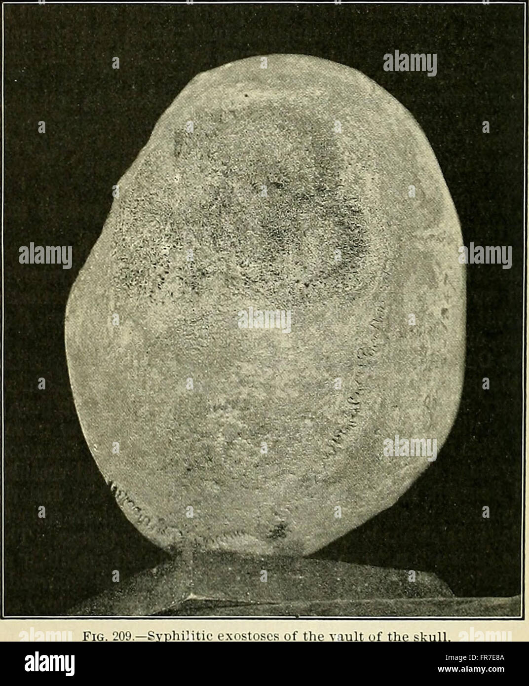 An American text-book of genito-urinary diseases, syphilis and diseases ...