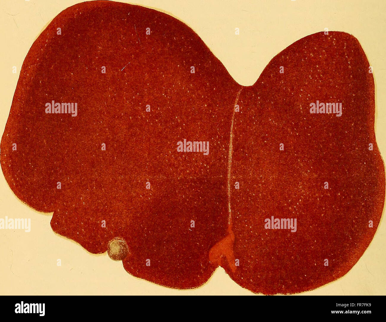 Sclerema Neonatorum Pathology