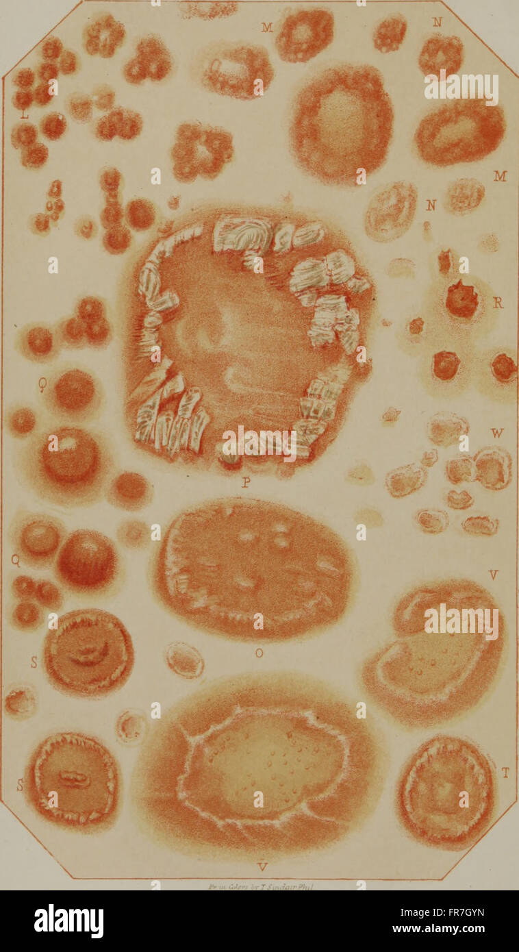 Syphilitic hi-res stock photography and images - Alamy