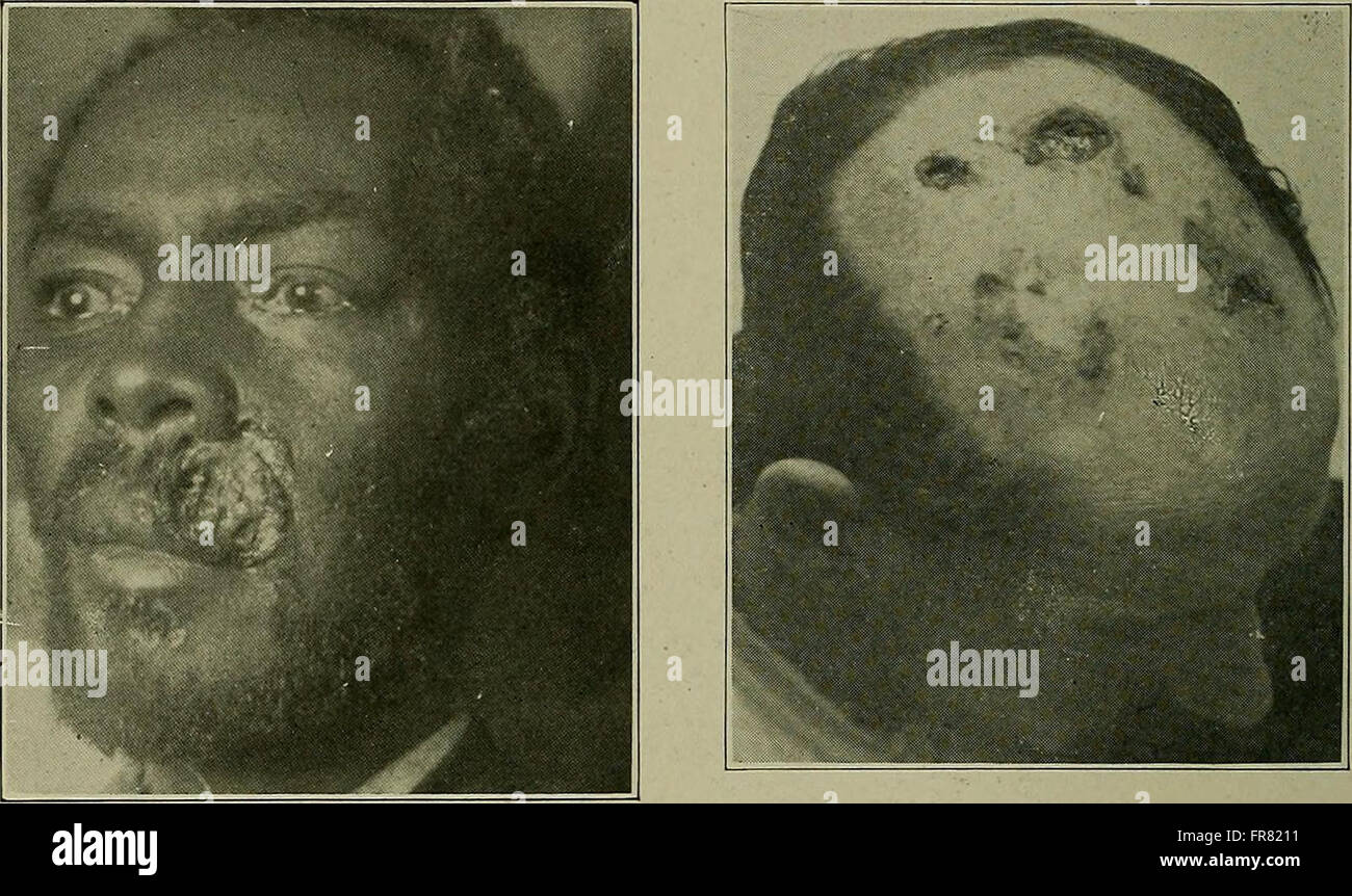 This 1921 treatise on syphilis covers the disease’s etiology, pathology ...