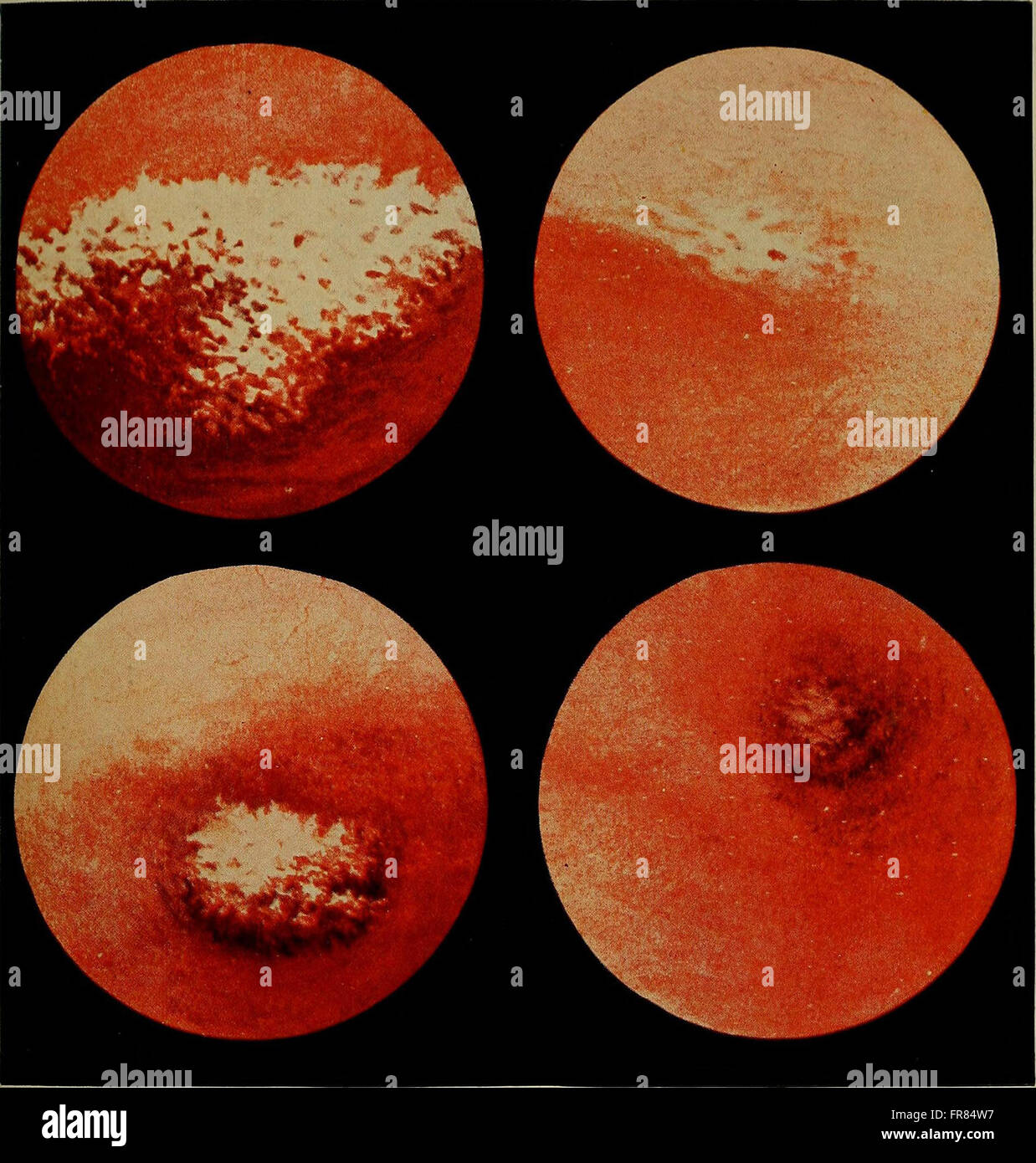 This 1921 treatise provides a detailed overview of syphilis, covering ...