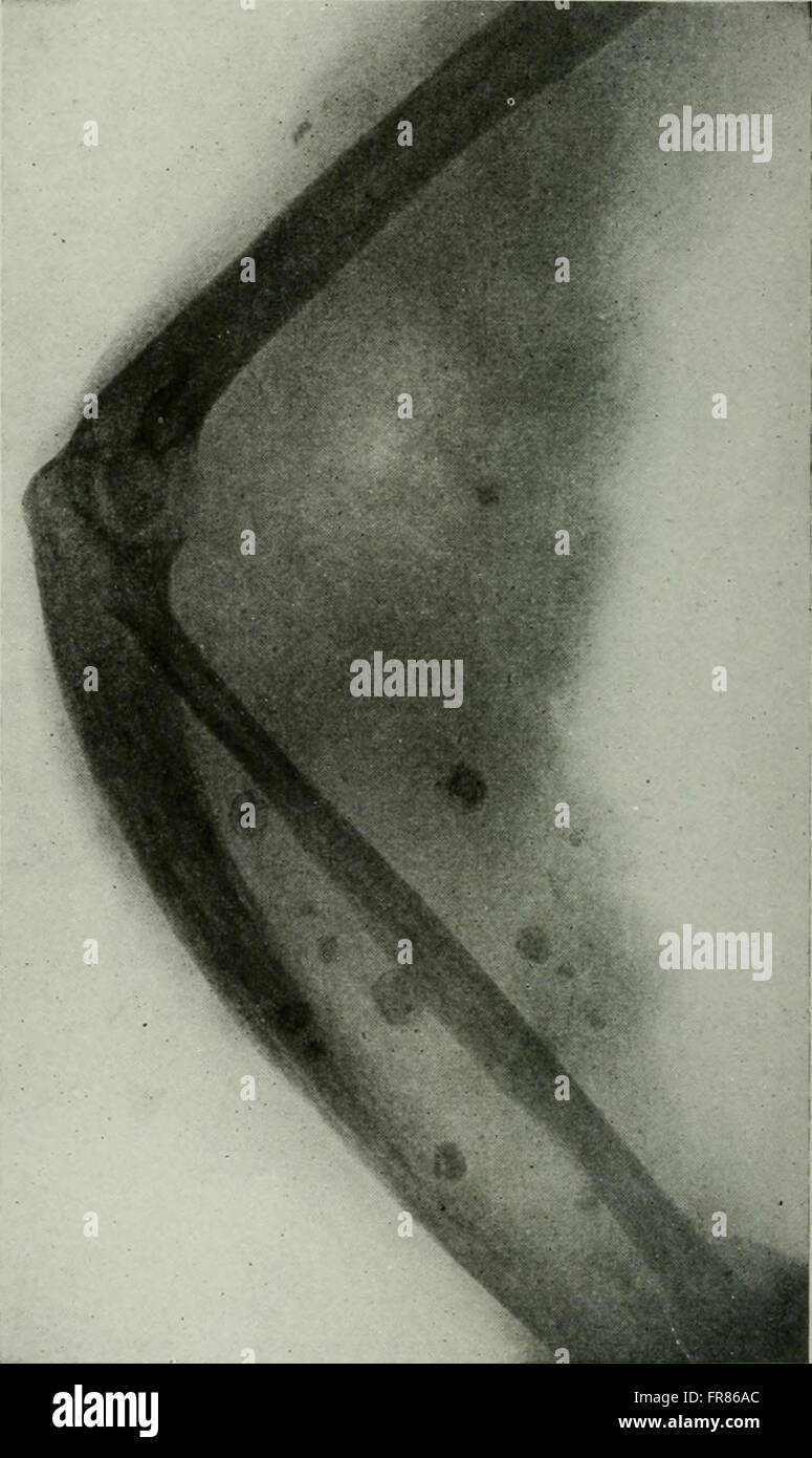 This 1906 journal explores the early use of X-ray, radium therapy, and ...
