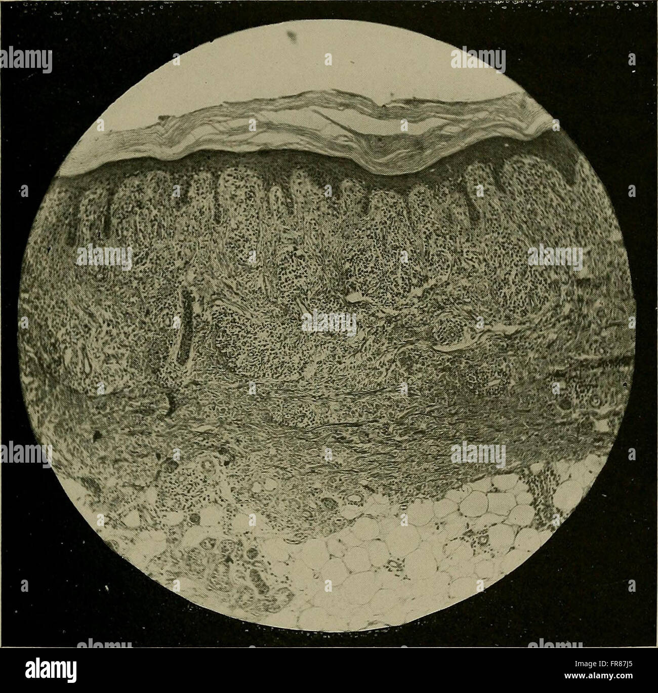 Syphilis - a treatise on etiology, pathology, diagnosis, prognosis ...