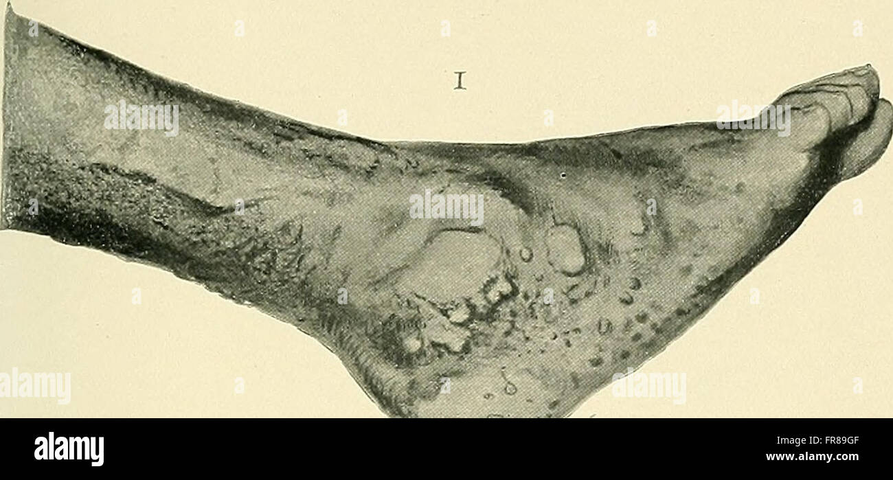 An American text-book of genito-urinary diseases, syphilis and diseases ...