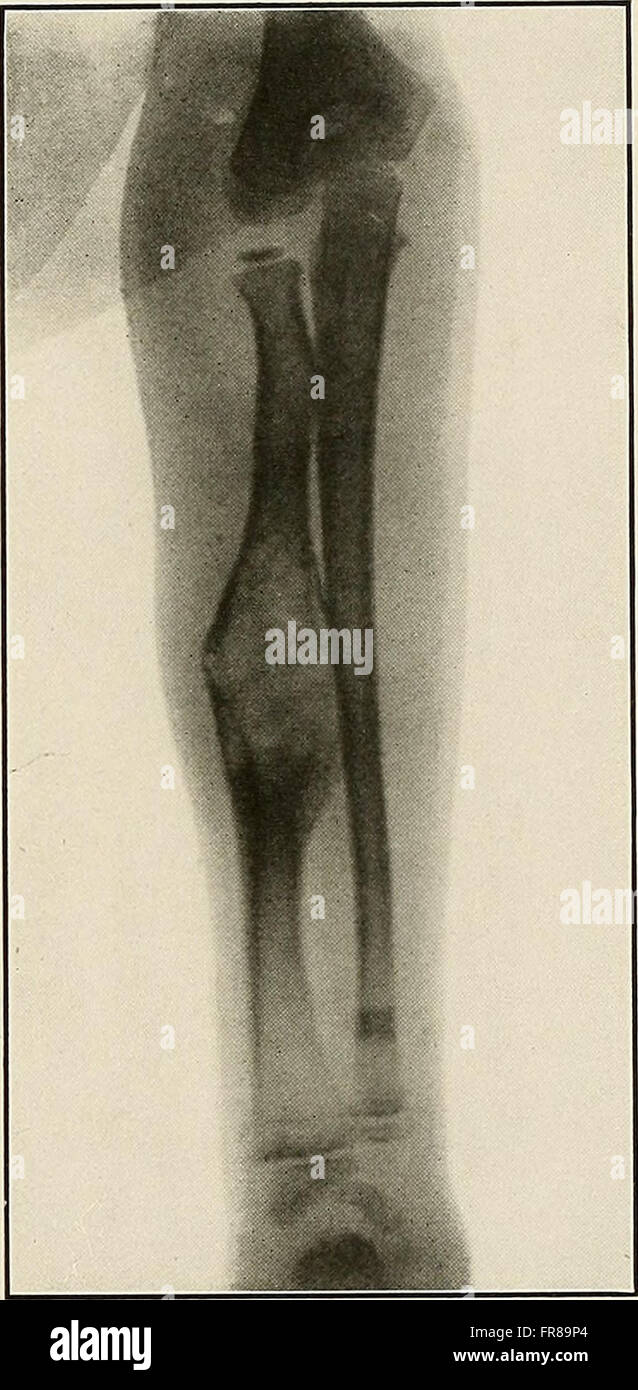 This 1911 medical atlas offers radiographic images illustrating ...