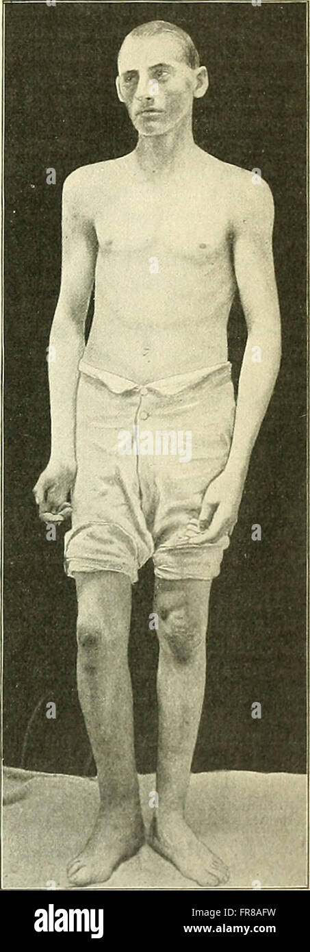 An American text-book of genito-urinary diseases, syphilis and diseases ...