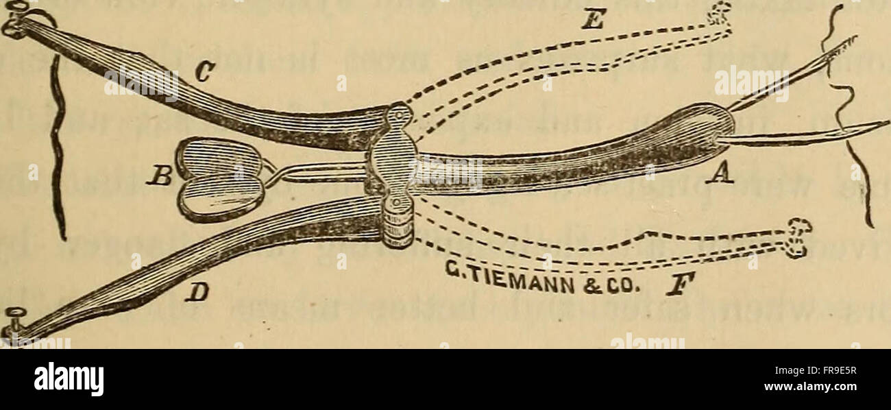 Strangulated hernia hi-res stock photography and images - Alamy