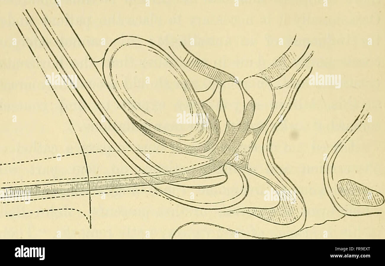 Clinical lectures on stricture of the urethra and other disorders of ...
