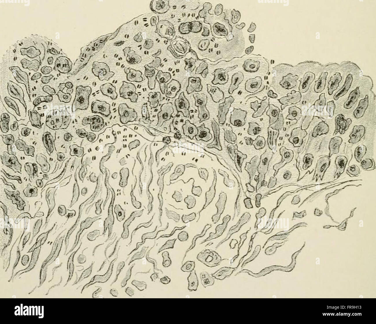 Dental pathology drawing hi-res stock photography and images - Alamy