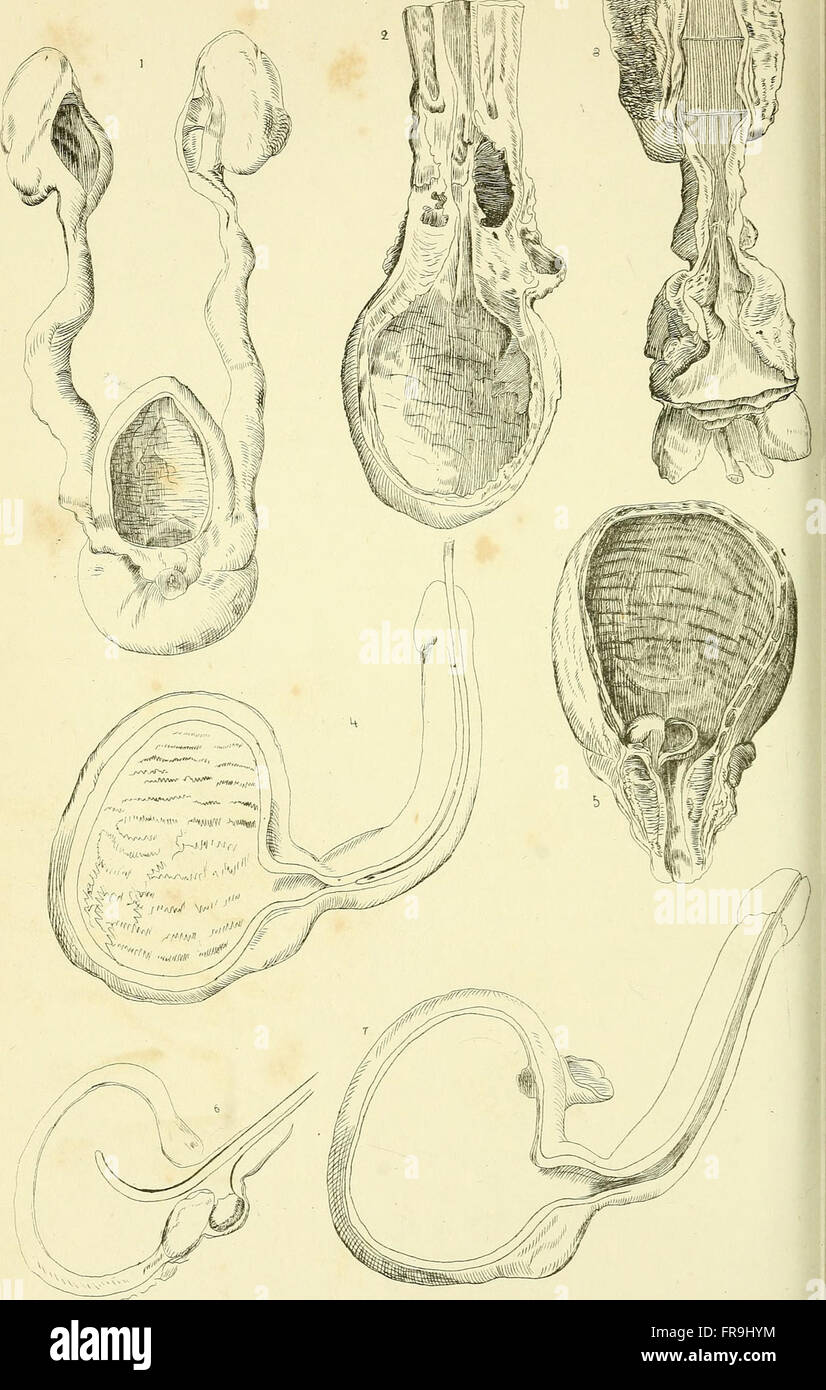This 1852 book illustrates various surgical procedures through over ...