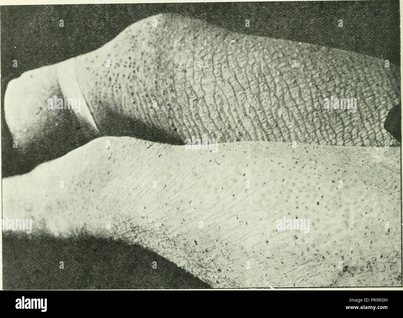 The British Journal of Dermatology, first published in 1888, covered ...