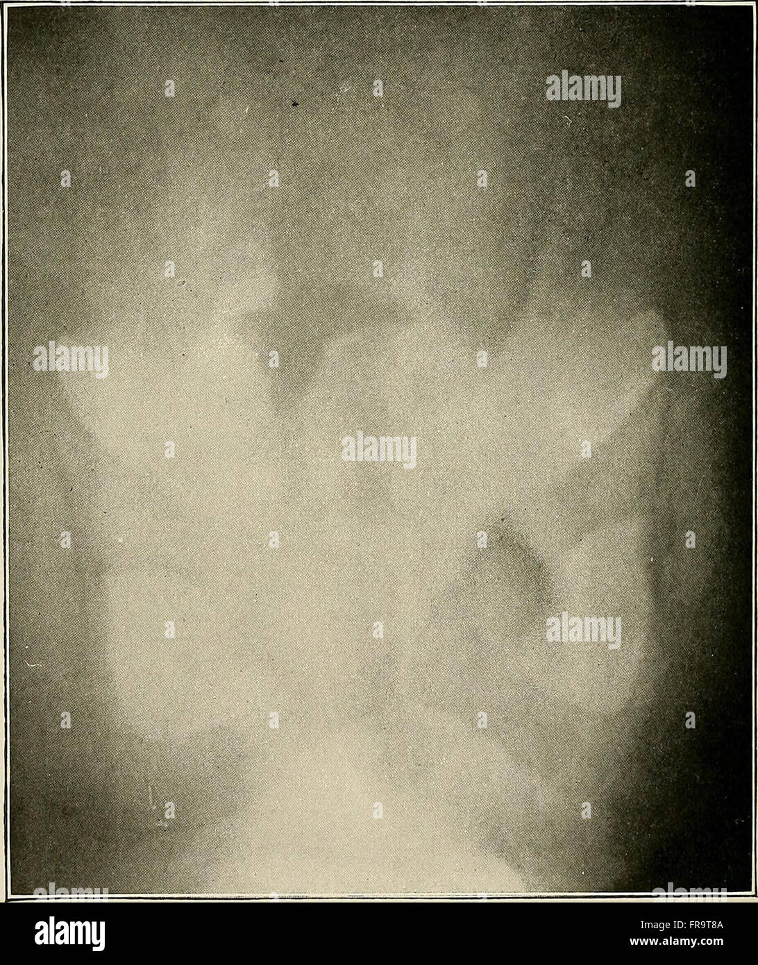 'Bismuth Paste in Chronic Suppurations' (1910) discusses the ...