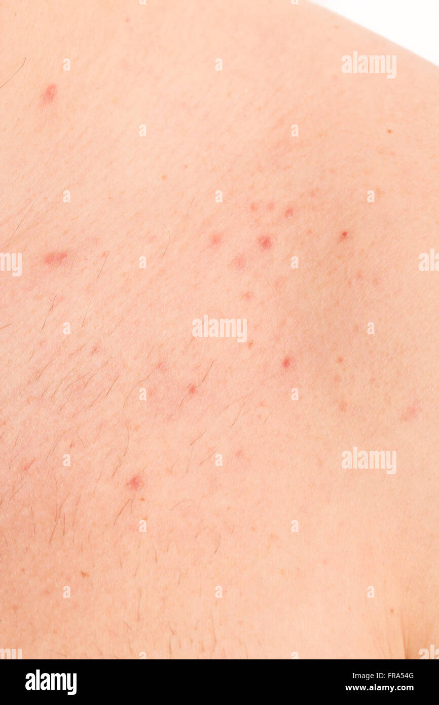 acne on male man back Stock Photo - Alamy