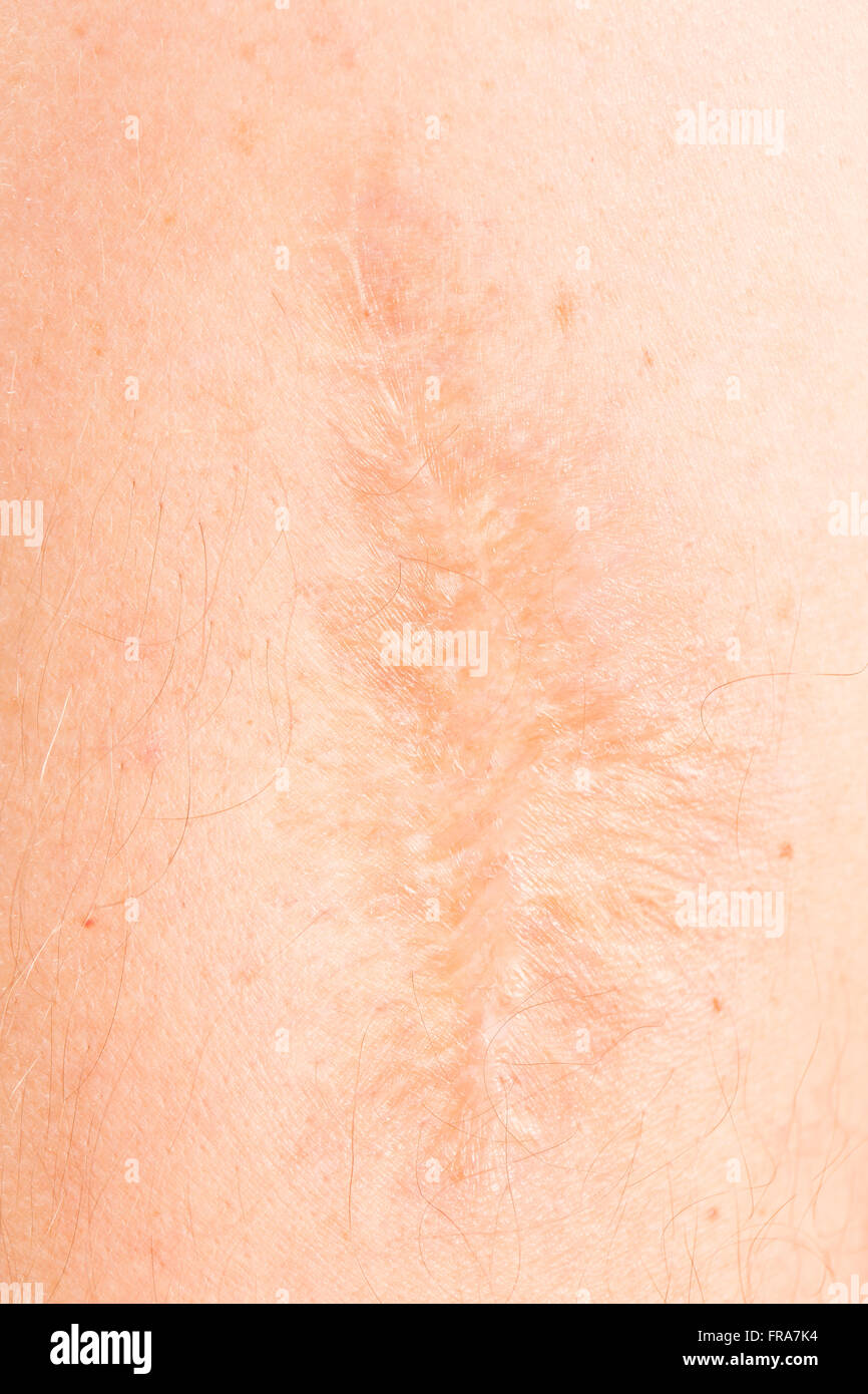 Surgery shoulder incision hi-res stock photography and images - Alamy