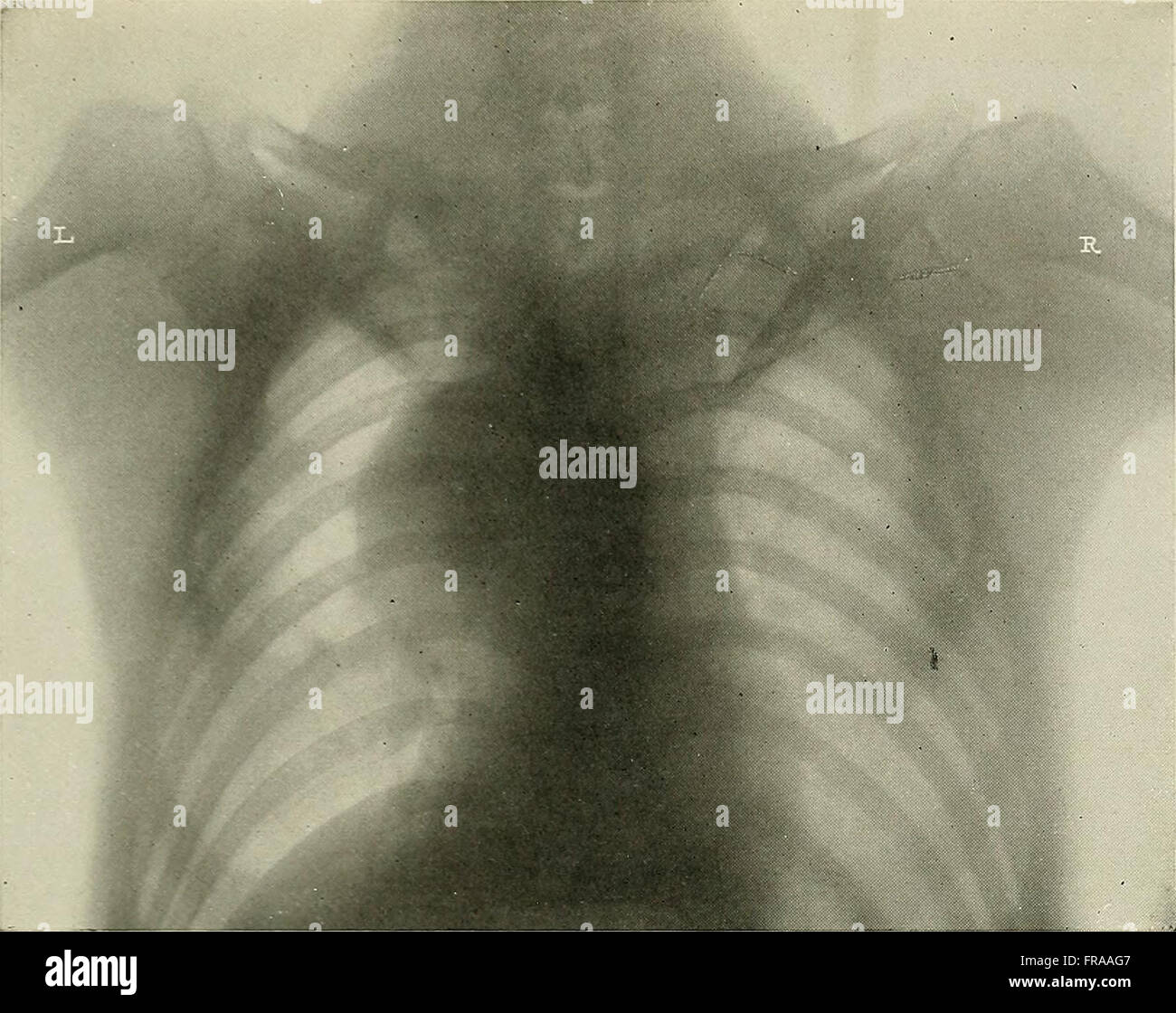'Röntgen Rays and Electro-Therapeutics' (1910) explores the use of X ...