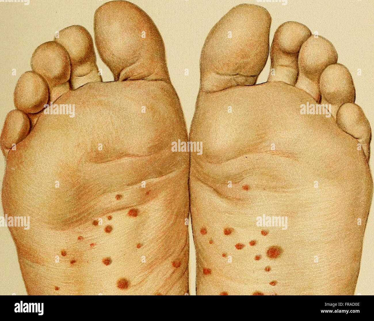 A manual of syphilis and the venereal diseases, (1900 Stock Photo - Alamy