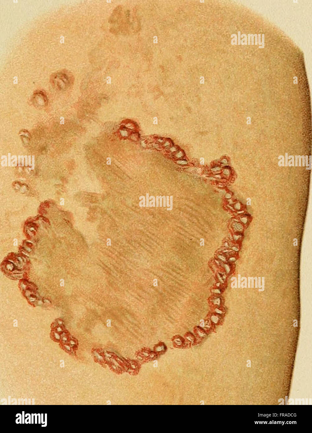 A manual of syphilis and the venereal diseases, (1900 Stock Photo - Alamy