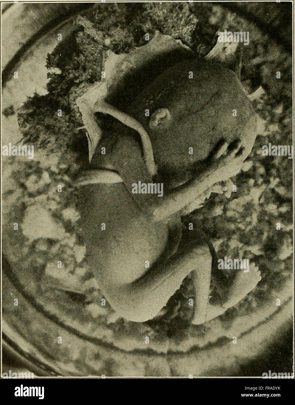 This 1908 study investigates the pathological causes behind human birth ...