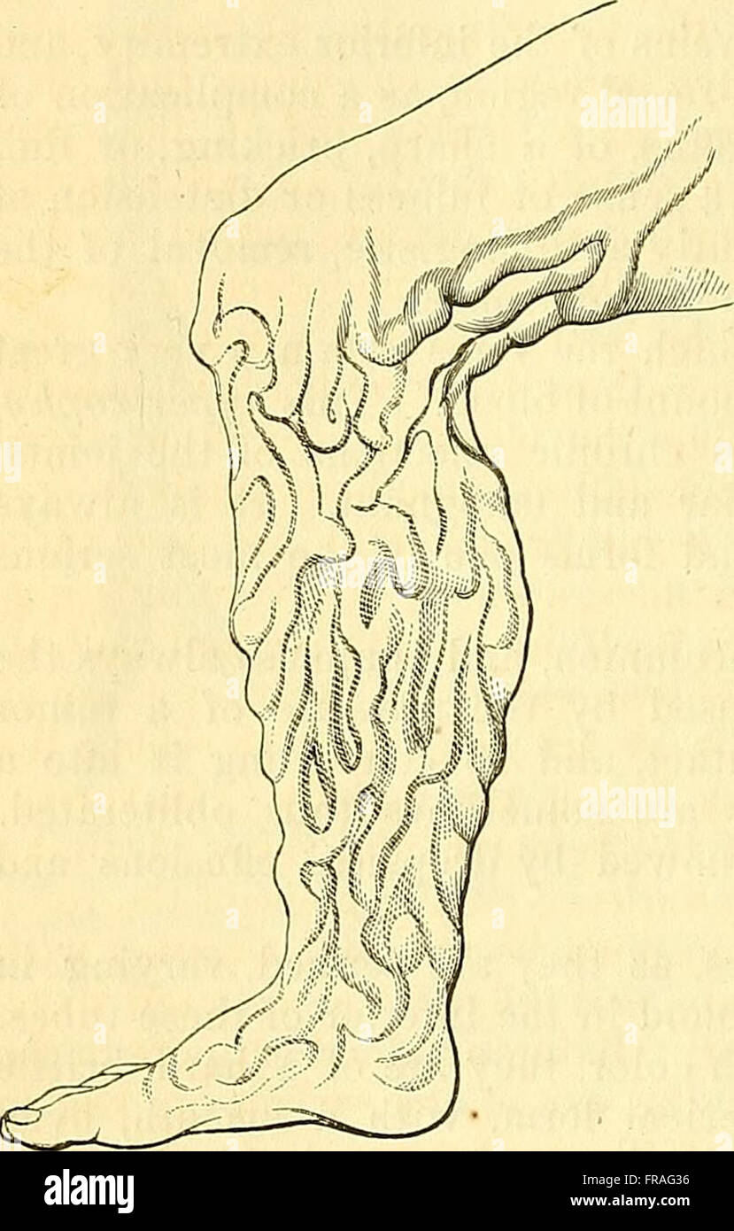 *A System of Surgery* (1866) is a comprehensive medical text covering ...