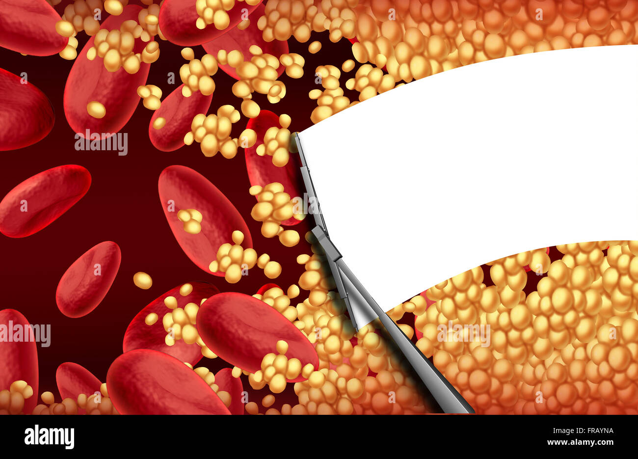 Blood cleansing a clogged artery with a wiper cleaning cholesterol ...