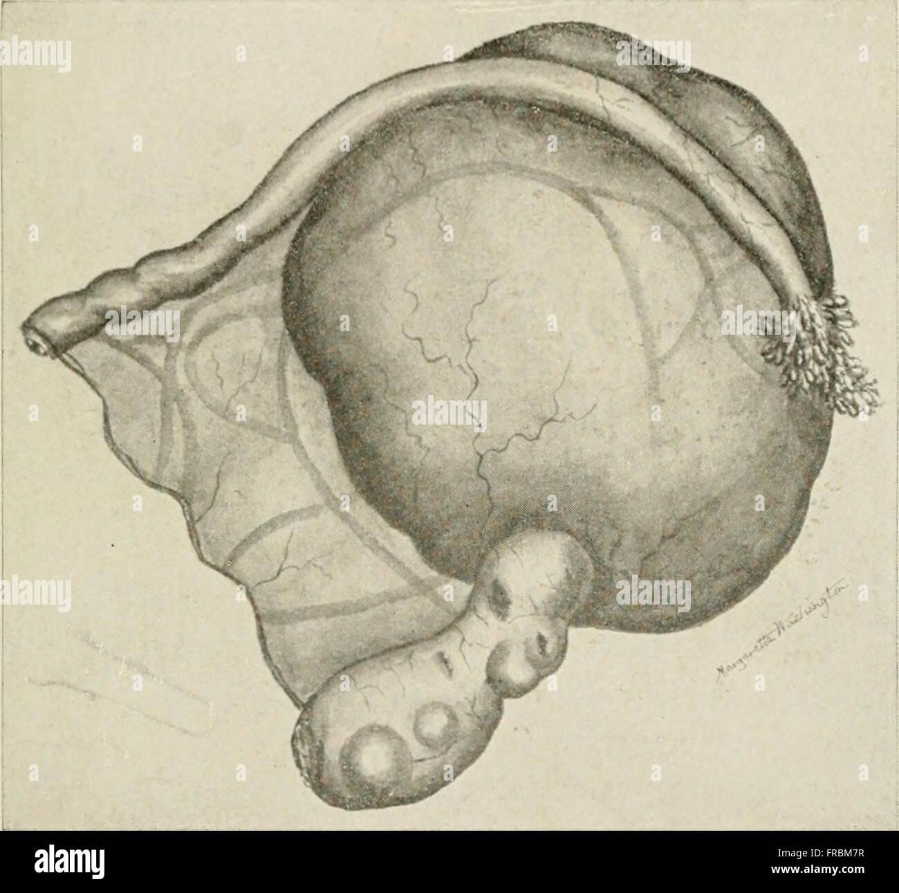 Dental pathology drawing hi-res stock photography and images - Alamy