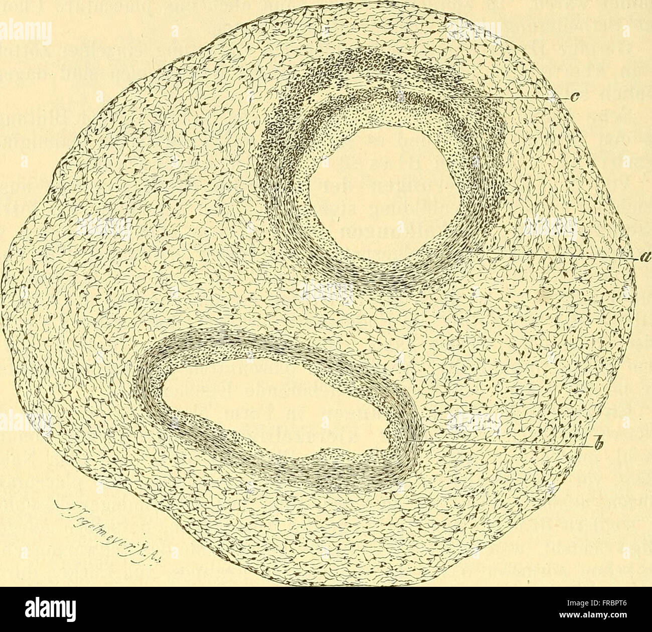 A 1887 textbook on general pathological anatomy and pathogenesis ...