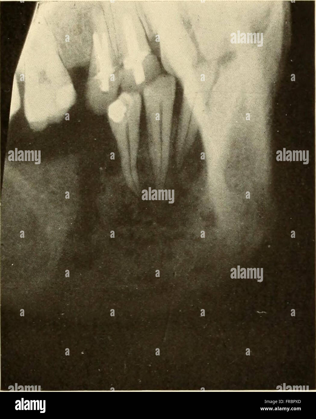 This 1917 publication explores the use of X-rays (Roentgen rays) in ...