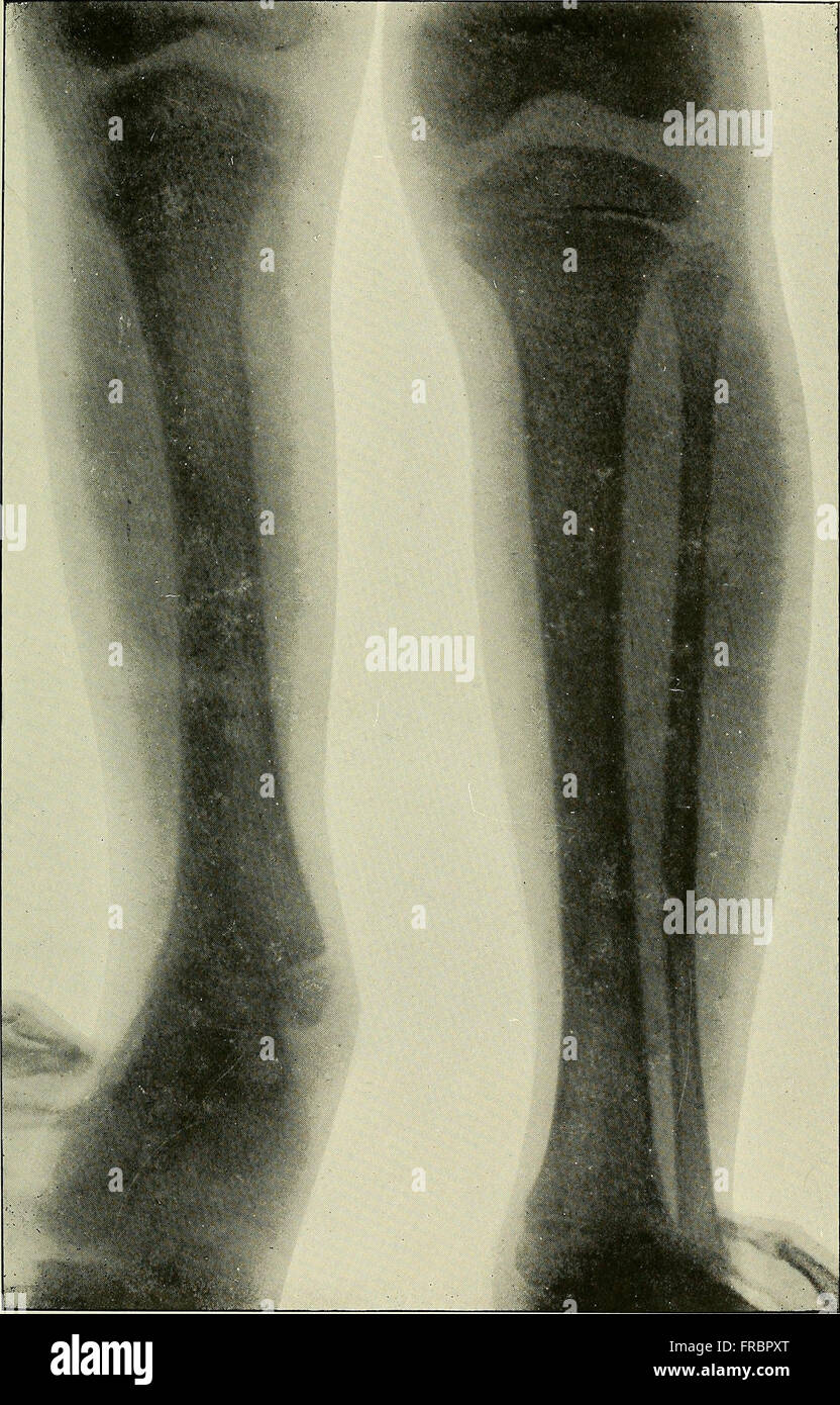 Lheredo syphilis hi-res stock photography and images - Alamy