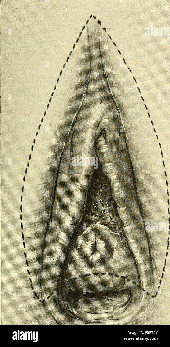 A 1906 medical textbook on operative gynecology, detailing surgical ...