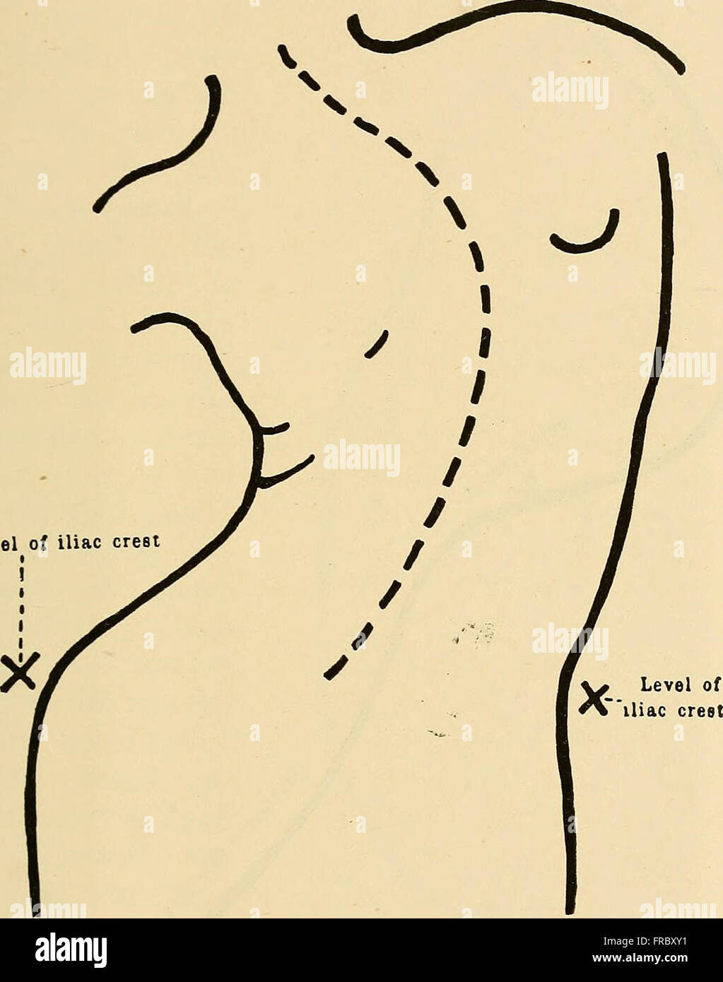 Lateral curvature of the spine hi-res stock photography and images - Alamy