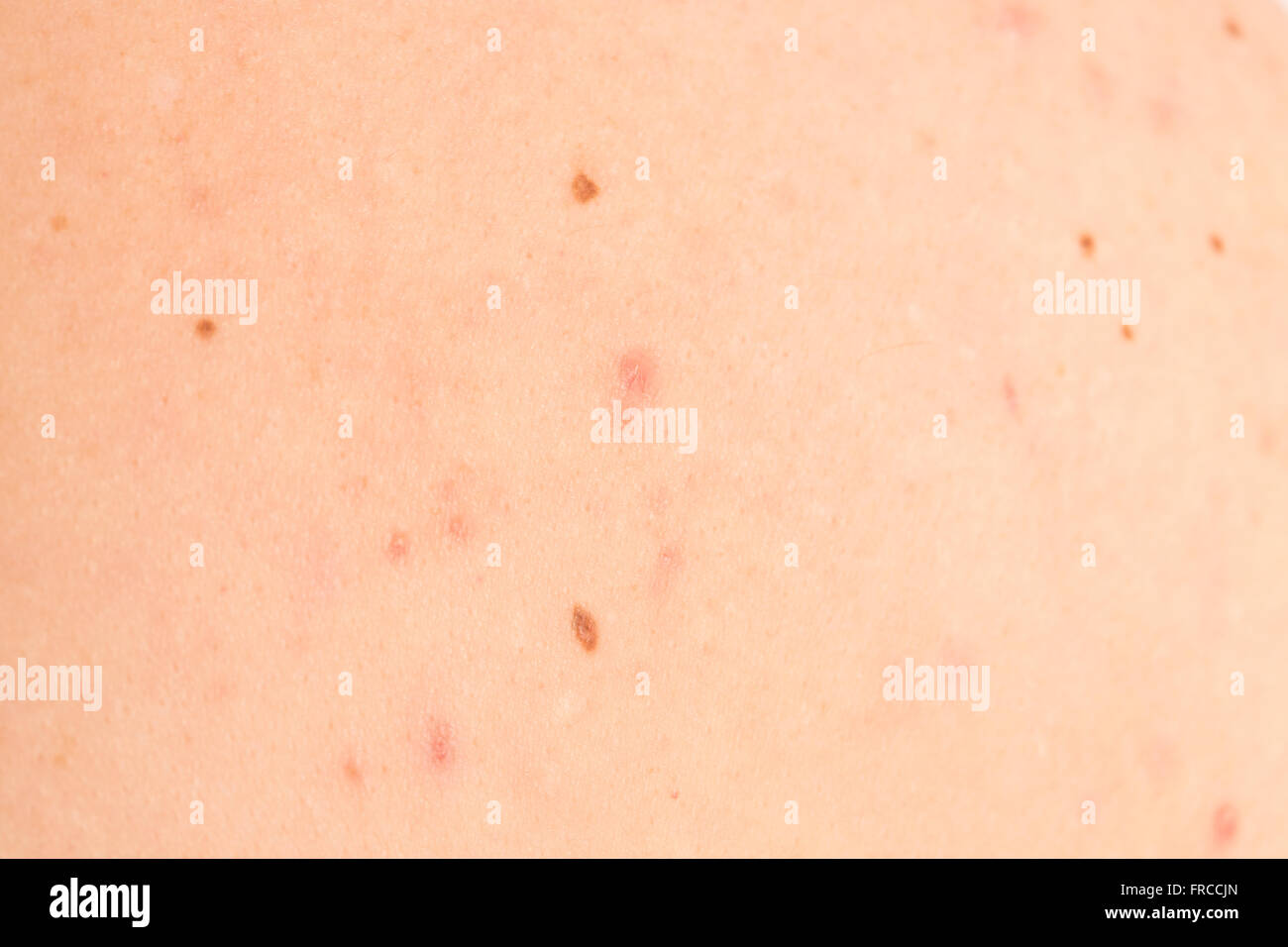 Acne and blemishes hi-res stock photography and images - Alamy