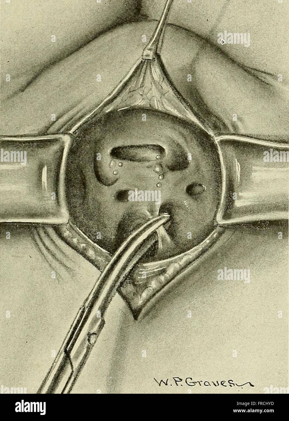 Gynecology - (1918 Stock Photo - Alamy