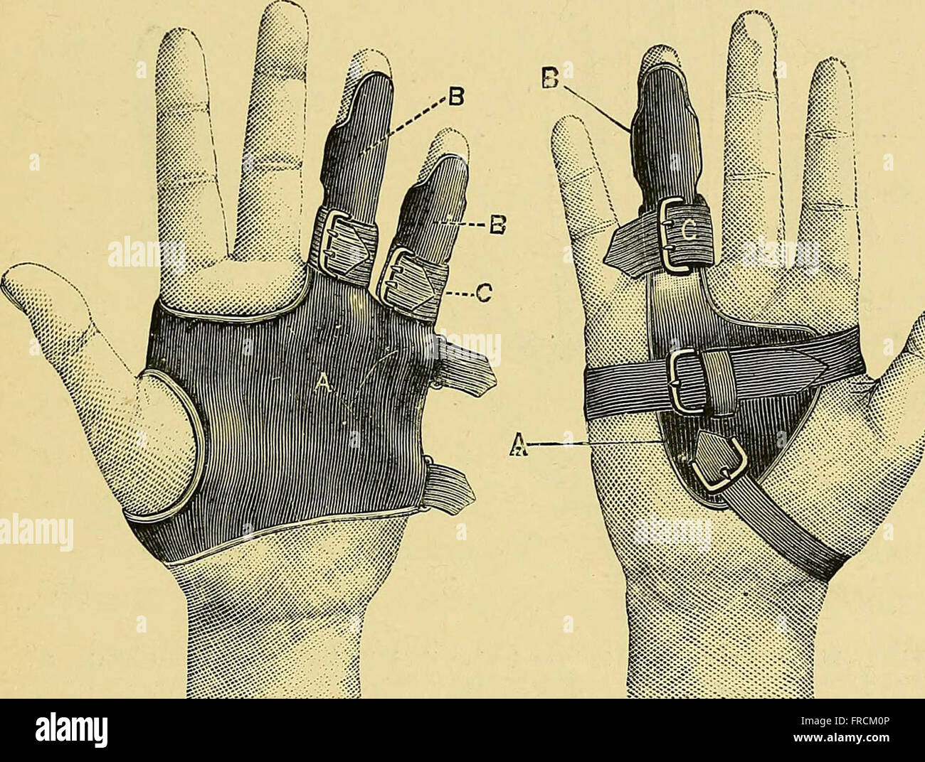 Dupuytrens contracture hand surgery hi-res stock photography and images ...