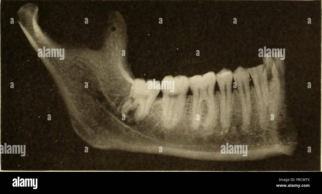 Oral Roentgenology - a Roentgen study of the anatomy and pathology of ...