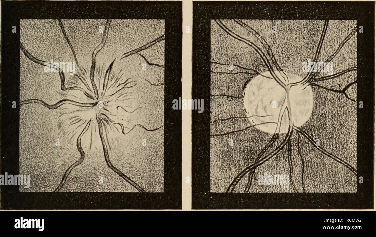 This 1911 medical text discusses the pathology and treatment of nervous ...