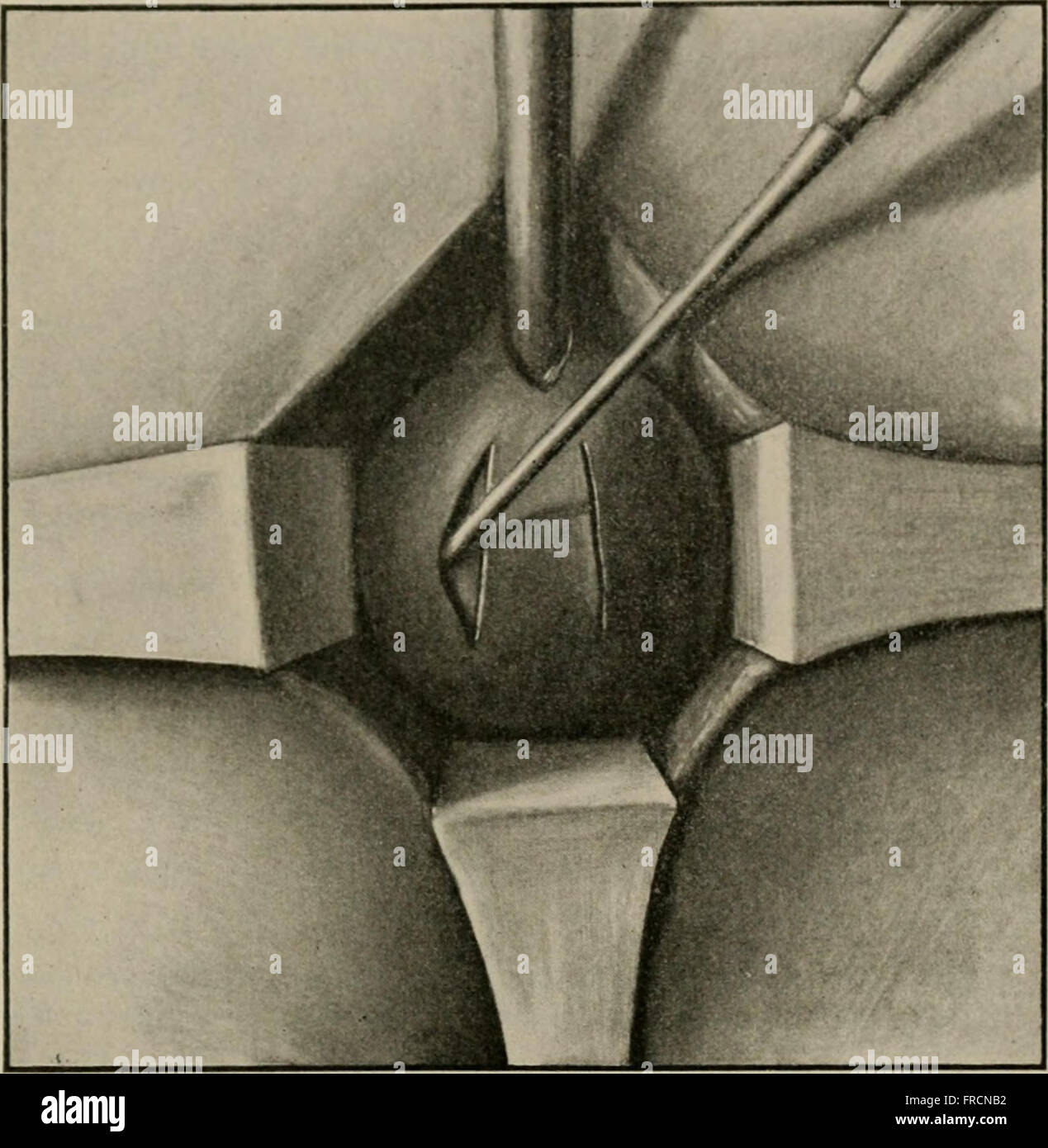 Operative surgery, for students and practitioners (1913 Stock Photo - Alamy