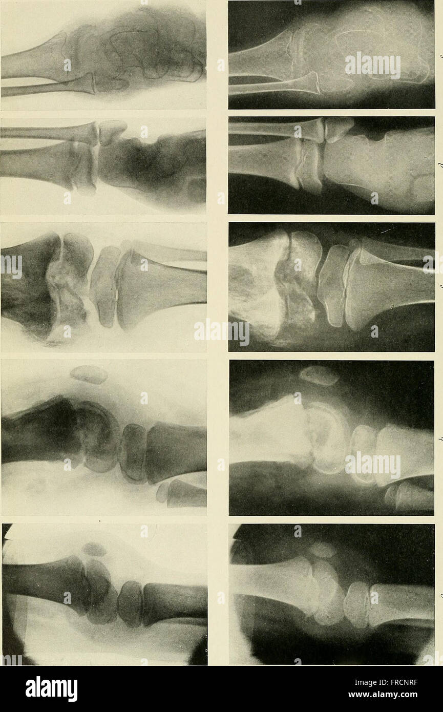 Radiography, x-ray therapeutics and radium therapy (1915 Stock Photo ...