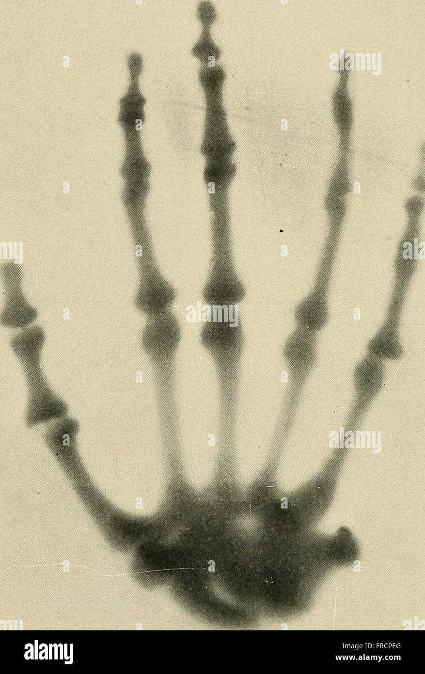 Roentgen Ray Diagnosis and Therapy (1904) is a medical text that ...