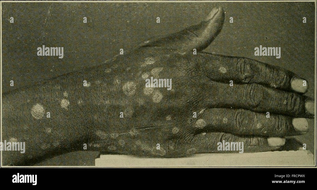 This 1921 treatise comprehensively covers syphilis, addressing its ...