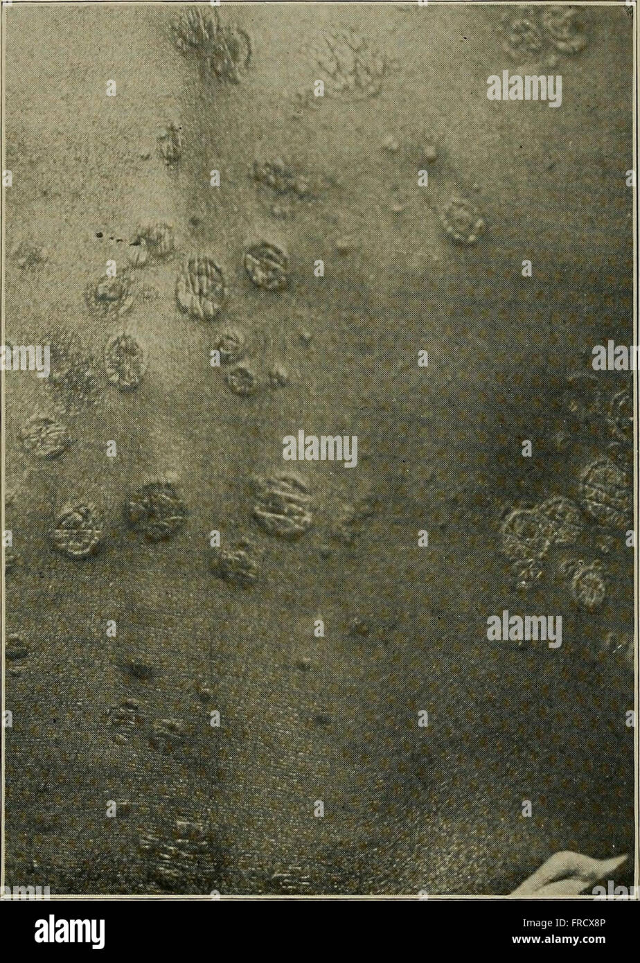 This 1921 treatise covers syphilis in detail, examining its causes ...