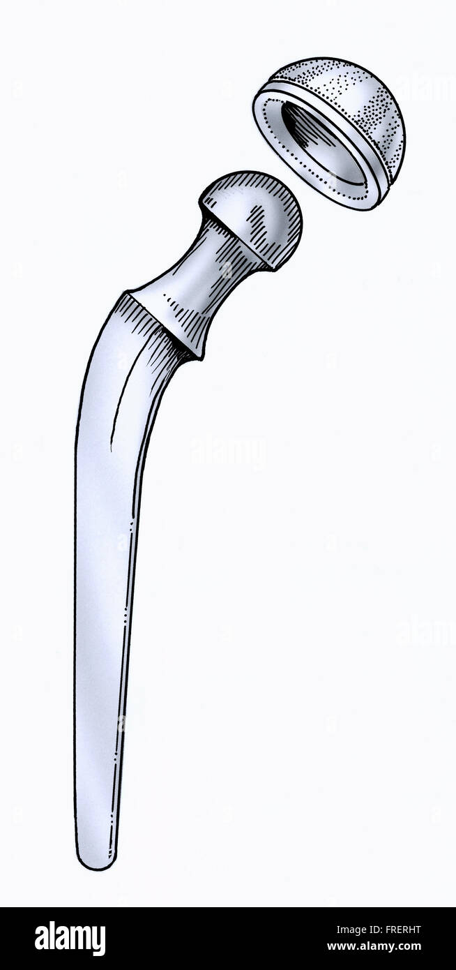 Pelvic socket and femoral component Stock Photo - Alamy