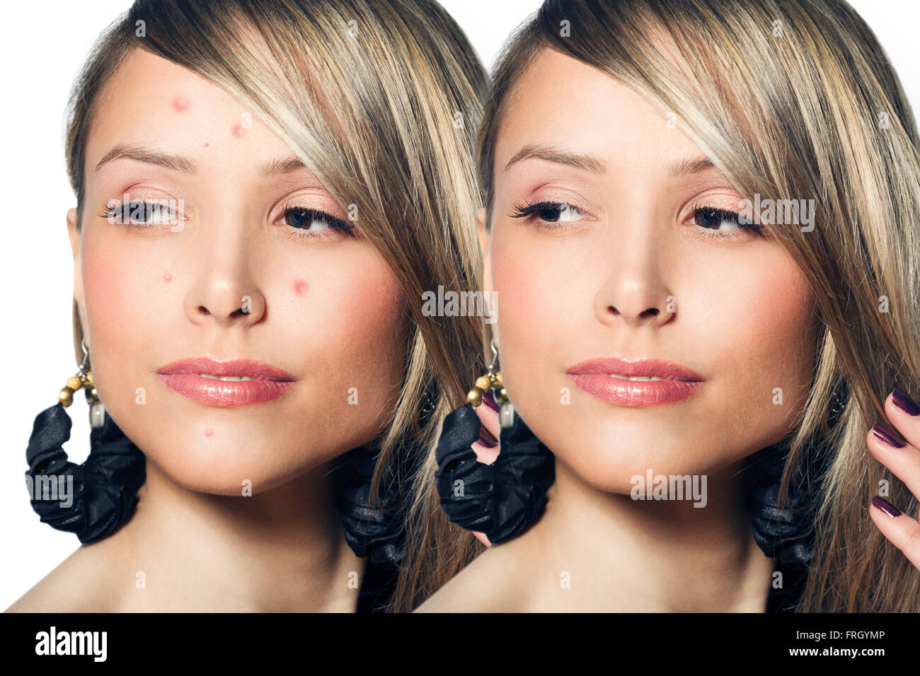 Woman with problem skin on her face Stock Photo - Alamy
