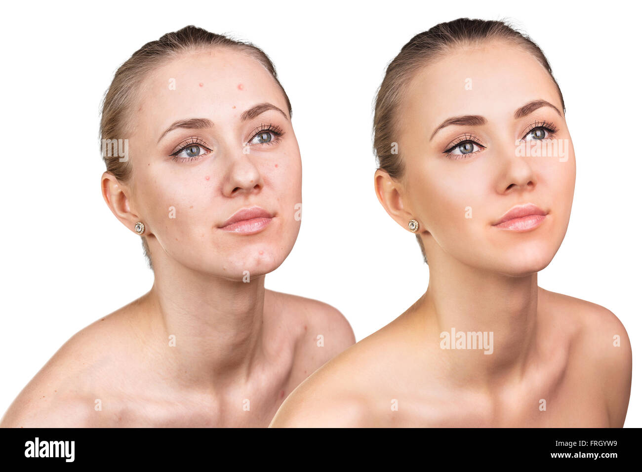 Woman with problem skin on her face Stock Photo - Alamy